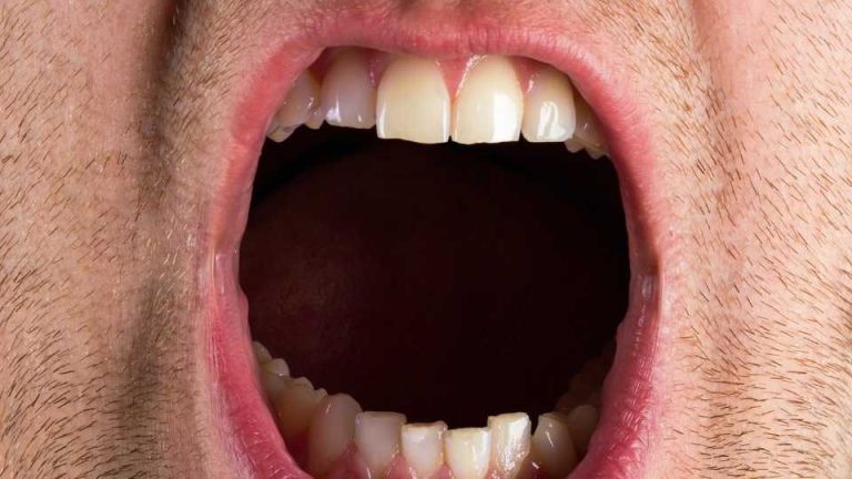 What Is Meth Mouth? Why Does It Happen, and Can It Be Reversed ...